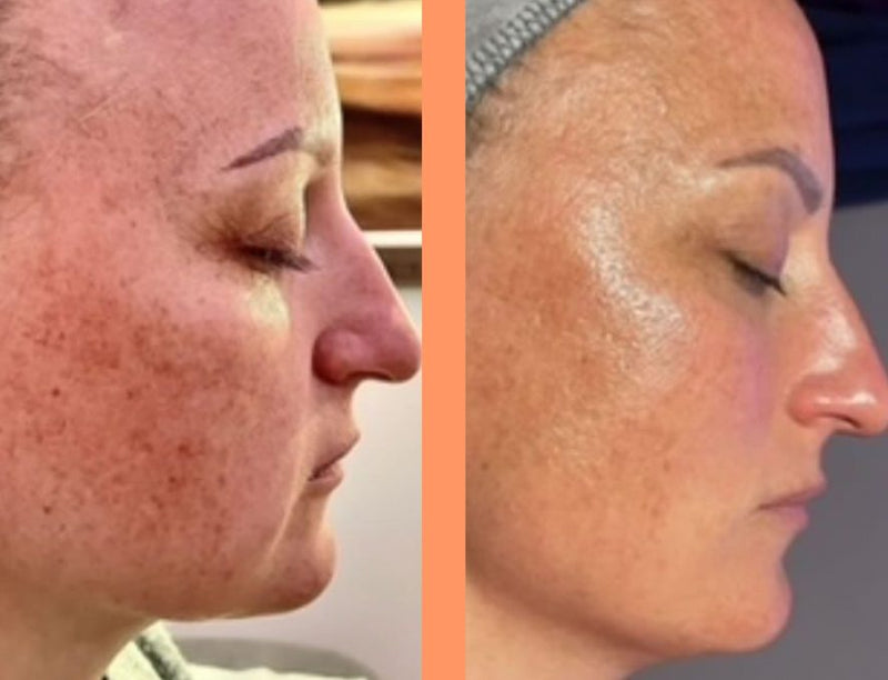 NeoGen Plasma Treatment | Dr. Johanna Ward London